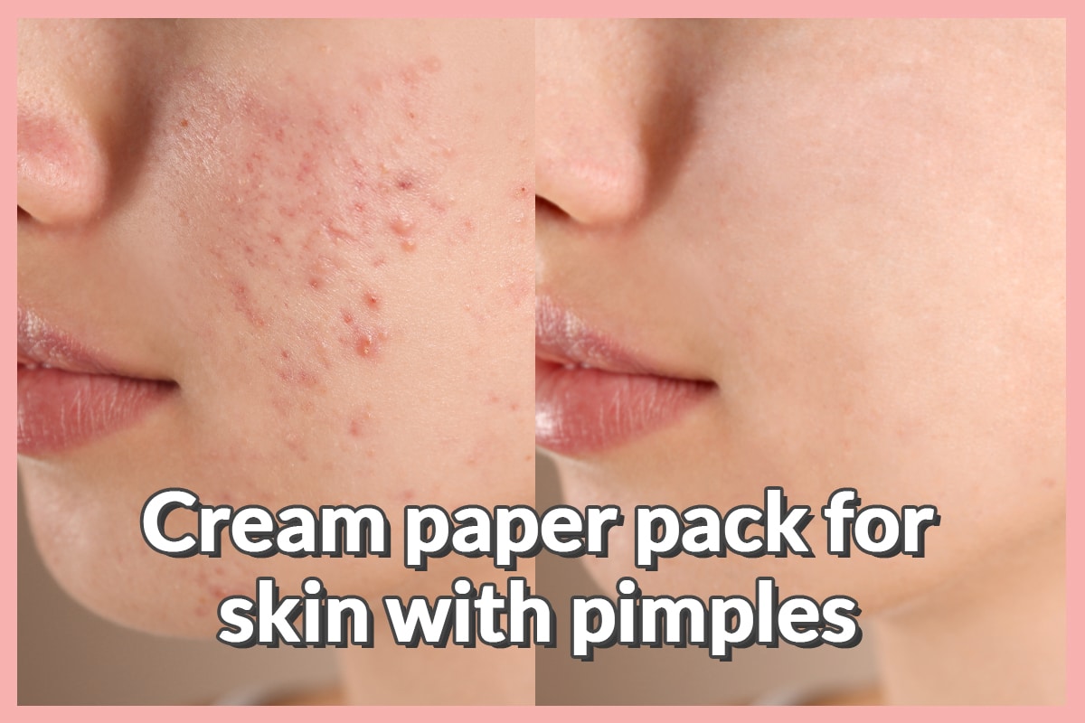 Fight against the comedonal acne! Cream paper pack for skin with pimpl ...